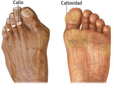 Eliminar los callos con láser